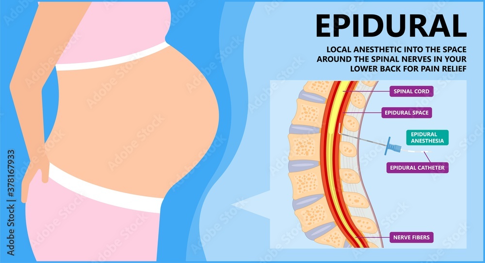 Epidural spinal block anaesthesia Pinched relieve General vaginal ...