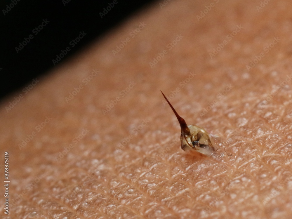 Bee sting are placed on the skin. Focus on the sting. Stock Photo ...