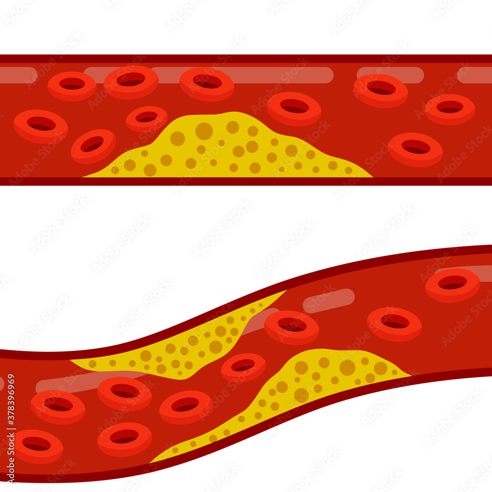 Blood cholesterol. Veins and arteries with fat. Problem with vascular ...