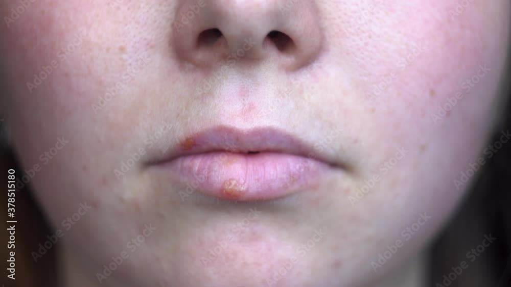 Close up of female lips infected by herpes virus. Media. Concept of ...