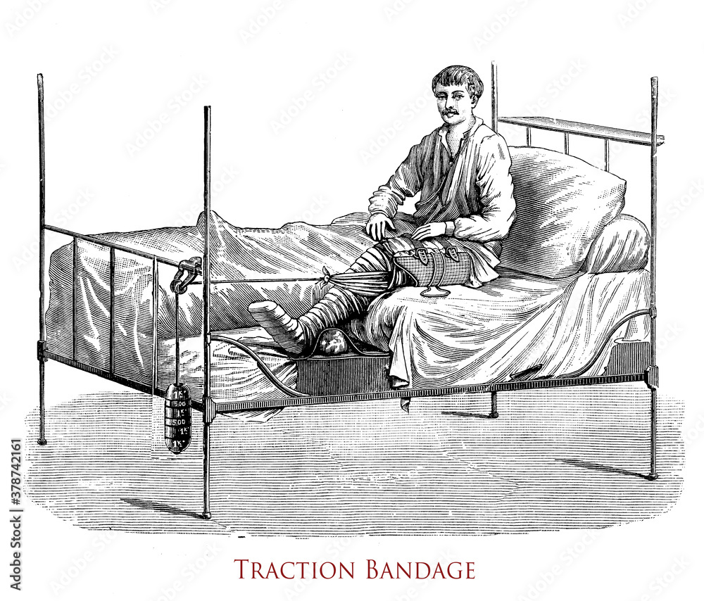 Healthcare and medicine: drawing explaining how to perform a traction ...