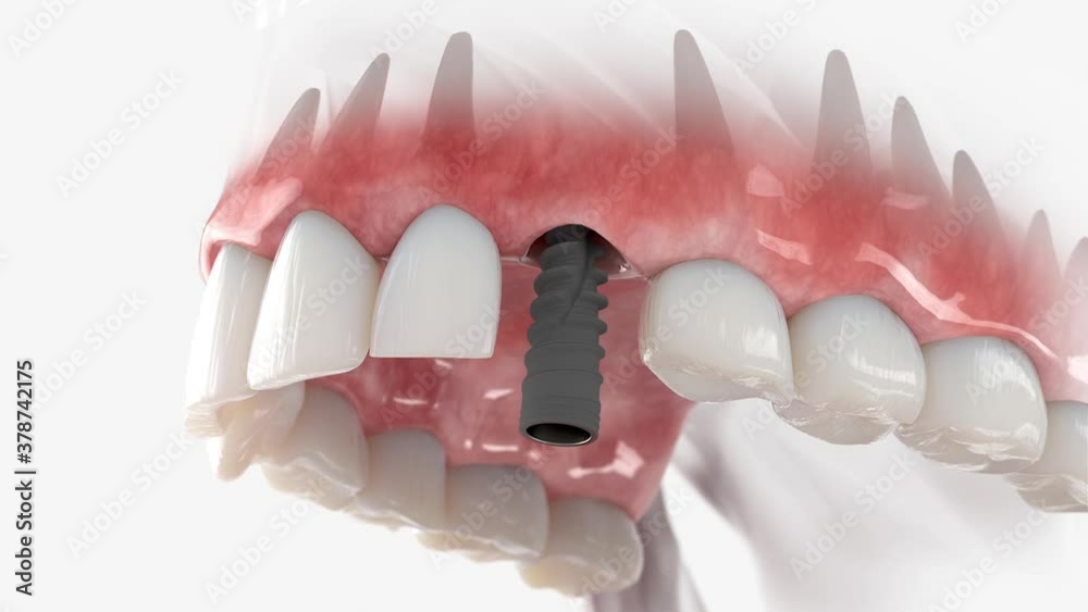 Replacement process of maxillary canine with a dental implant. Stock ...