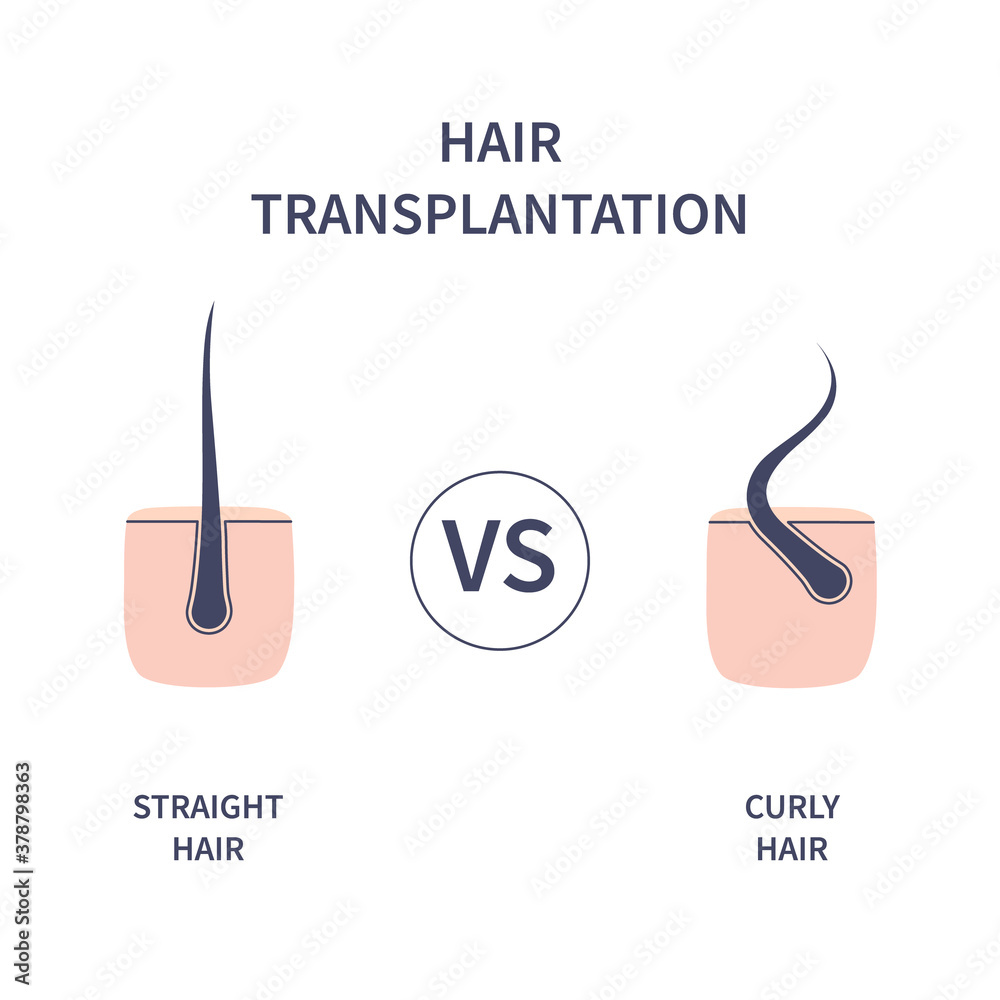 Hair transplantation for different hair types. Skin cross-section with ...