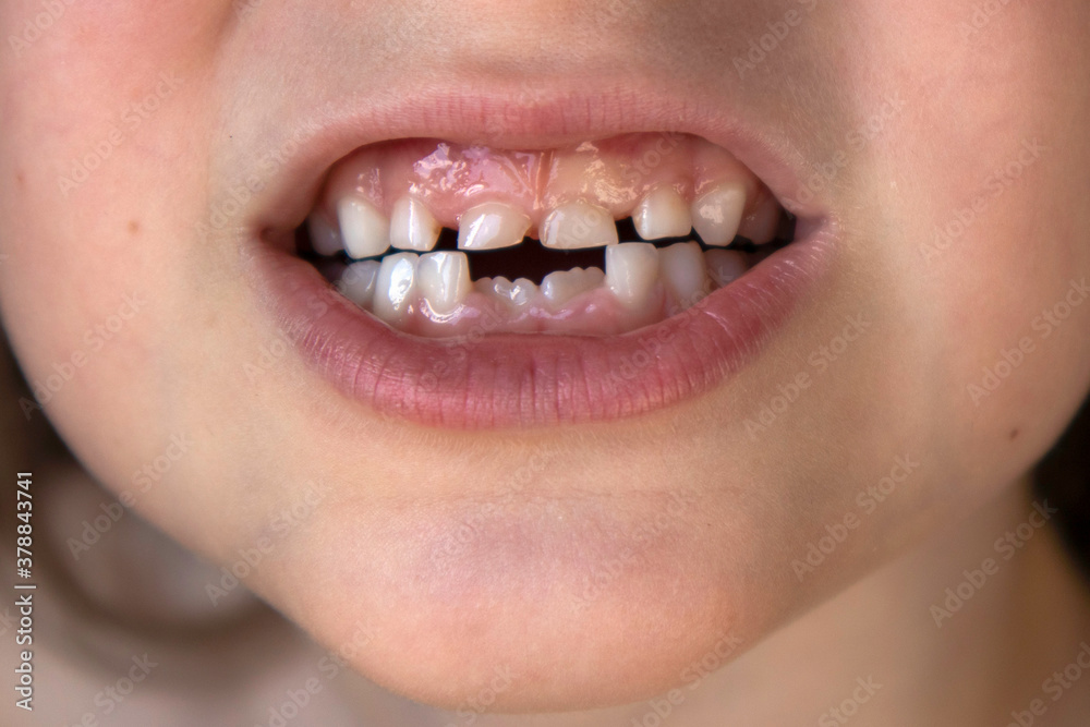 Foto de Baby milk teeth. The child has new teeth do Stock | Adobe Stock