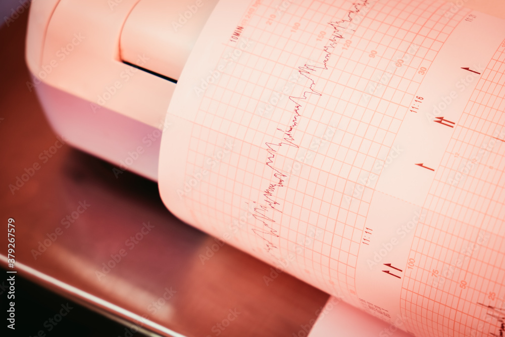 Printing Richter scale of cardiogram beat report coming out from ...