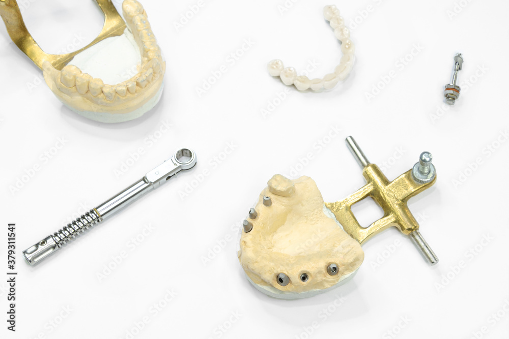 white ceramic teeth with dental implants on a white background. torque ...