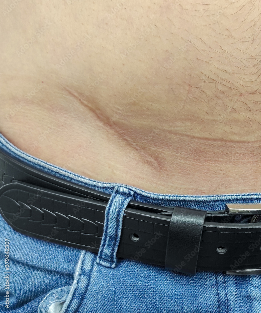 appendicitis scar on male belly in jeans Stock Photo | Adobe Stock