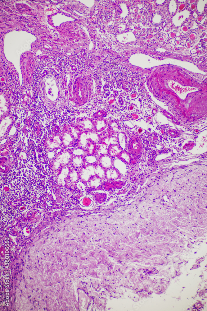 Compression atrophy of human kidney Stock Photo | Adobe Stock