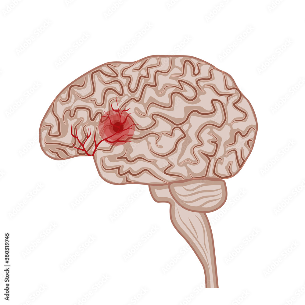 Human brain. Diseases of the brain, nervous system. Vector illustration ...