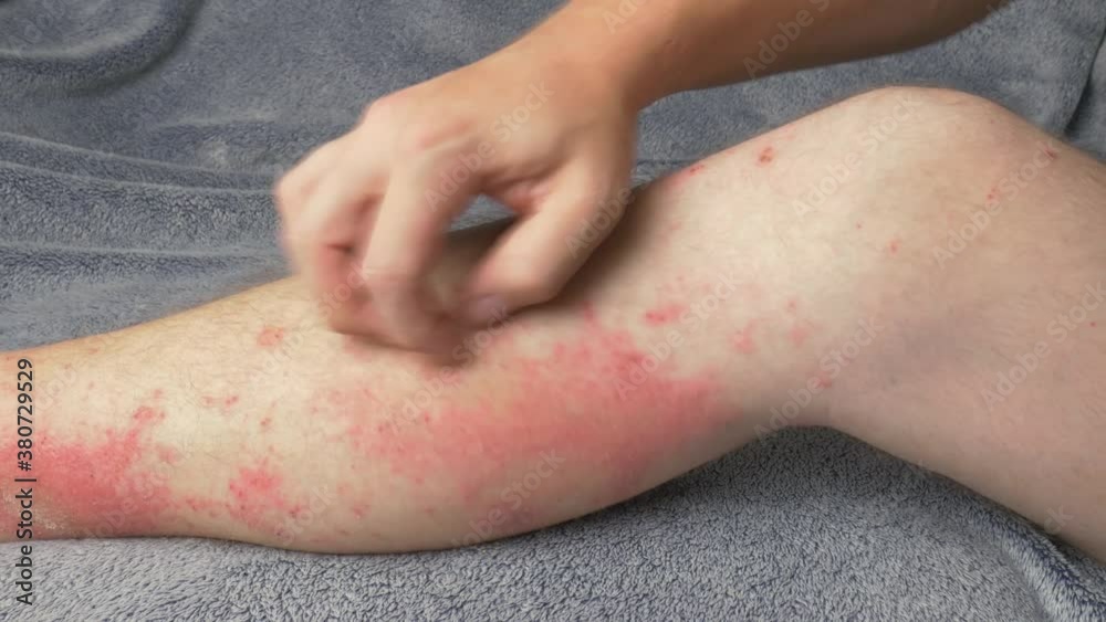 Man itching red blotchy reaction on lower leg caused by urushiol, found ...