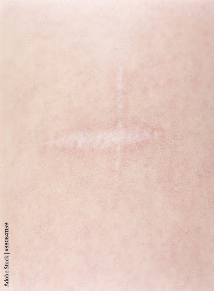 Scar Stock Photo | Adobe Stock