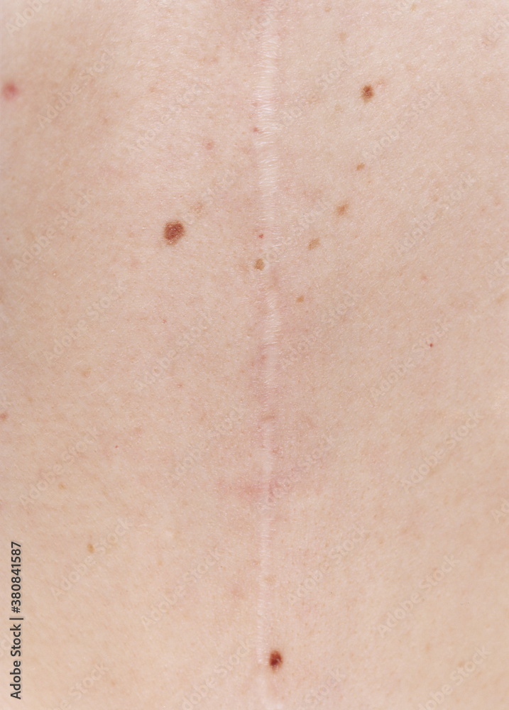 Scar Stock Photo | Adobe Stock