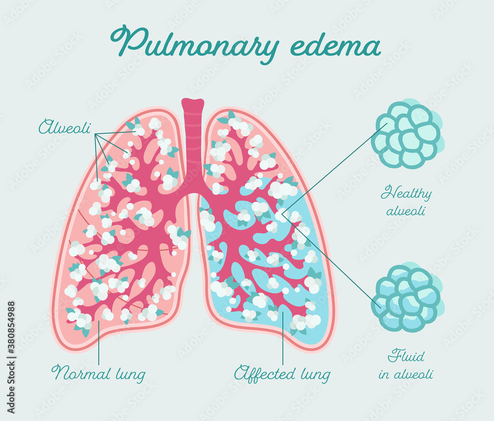 Pulmonary Edema Anatomical Scheme In Hand Drawn Style Collection Of Liquid In Human Lung