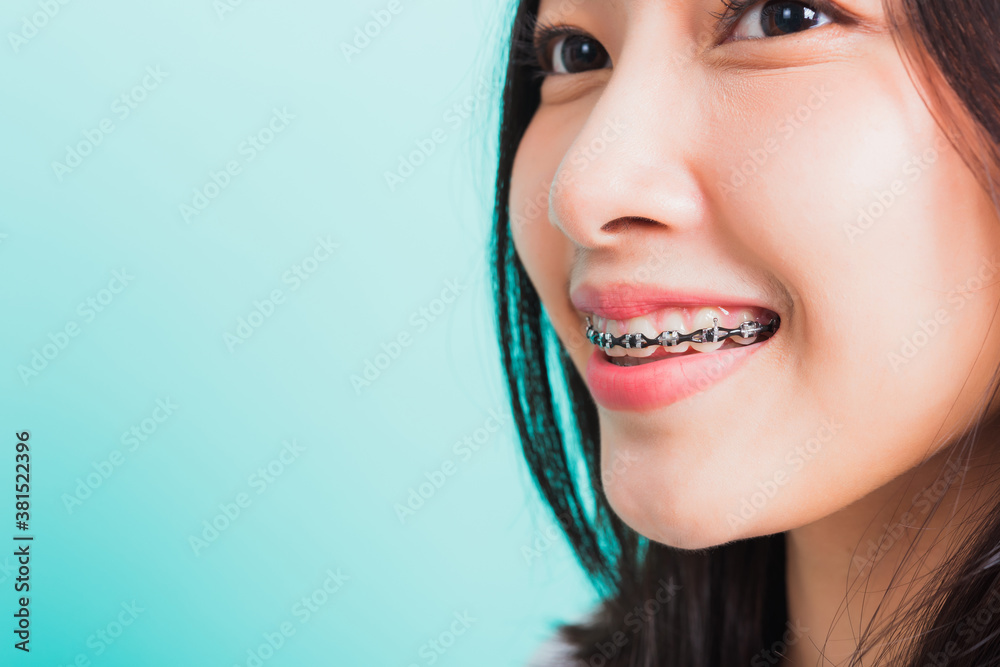 Closeup teen Asian beautiful young woman smile have dental braces on teeth laughing, studio shot ...