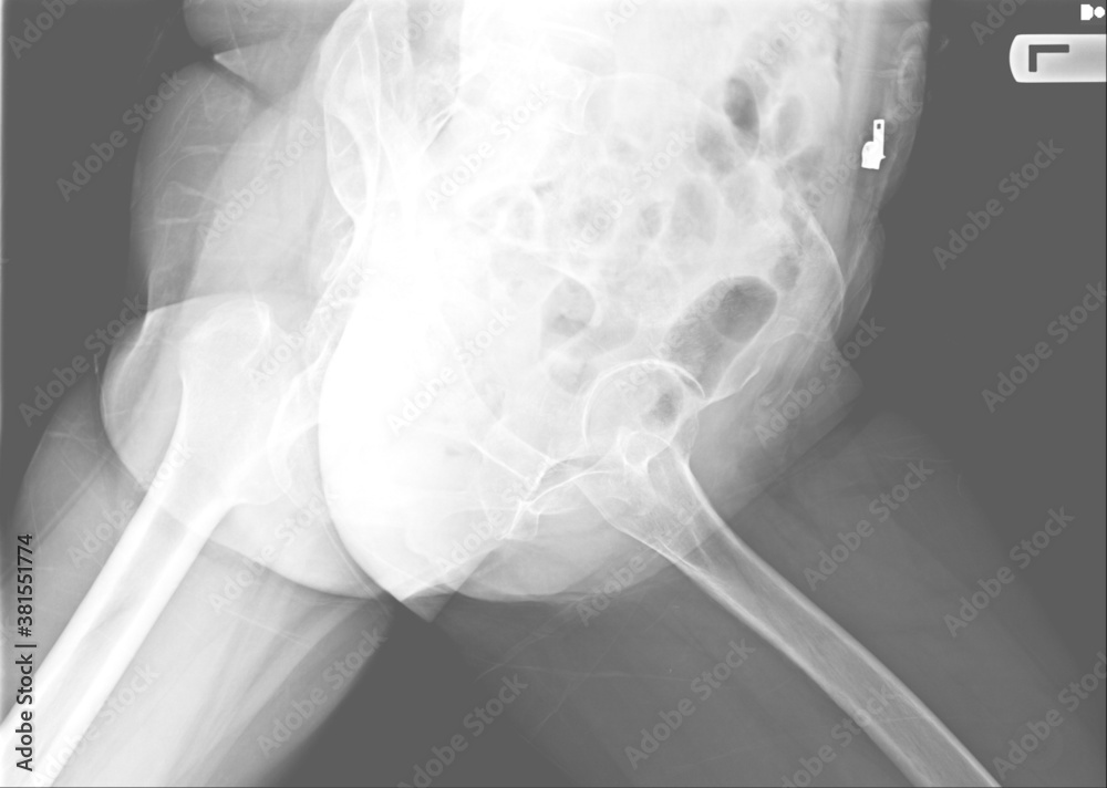 plain radiography of human hip joint in Judet's view show cortical ...