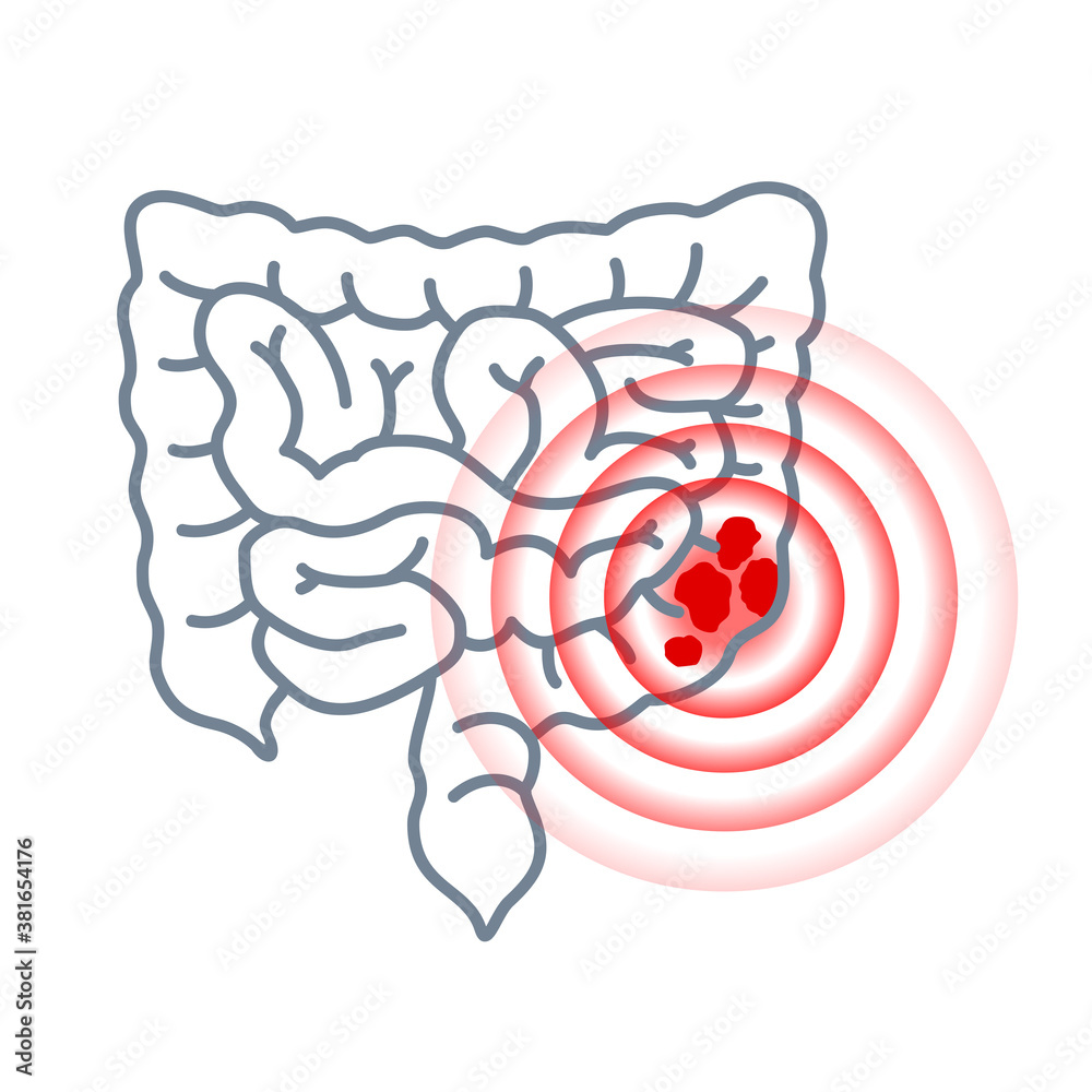 Colon cancer icon (Colorectal or bowel cancer) - human intestine and ...