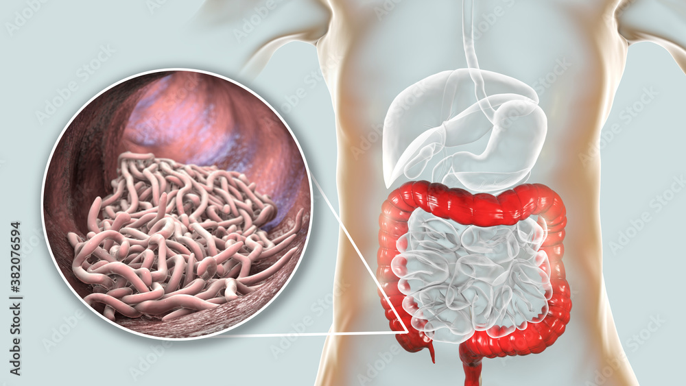 Parasitic worms in human large intestine Stock Illustration | Adobe Stock
