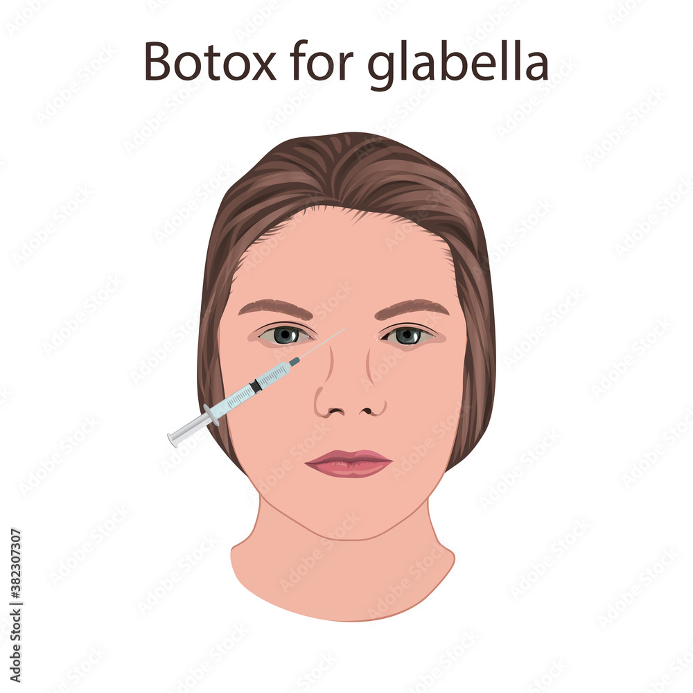 Botox for glabella. Young woman face with syringe. Vector illustration ...