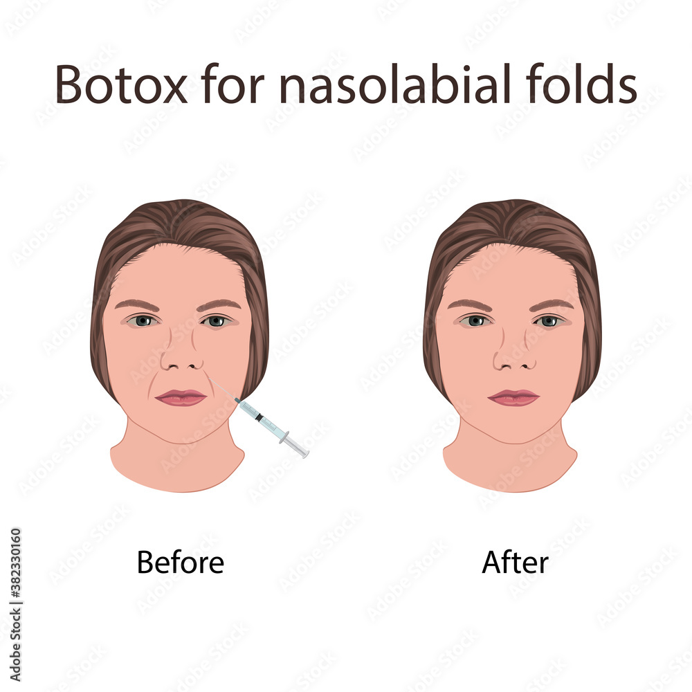 How Much Botox For Nasolabial Folds at Monica Baker blog