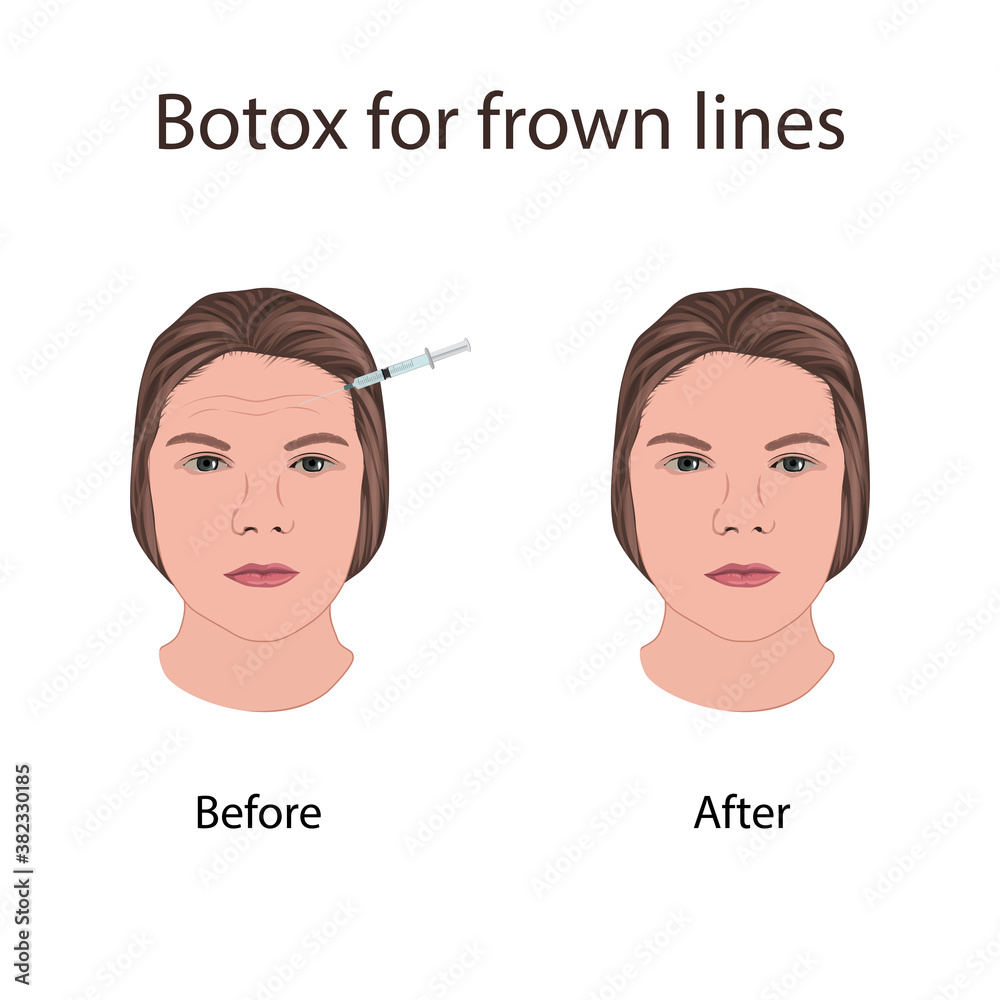 Botox for frown lines. Young woman face with syringe. Before and after ...
