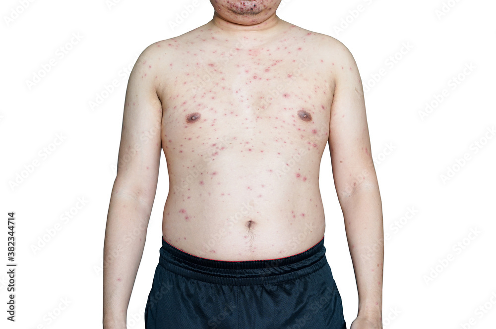 Chickenpox on the body isolated on white background, infection caused ...