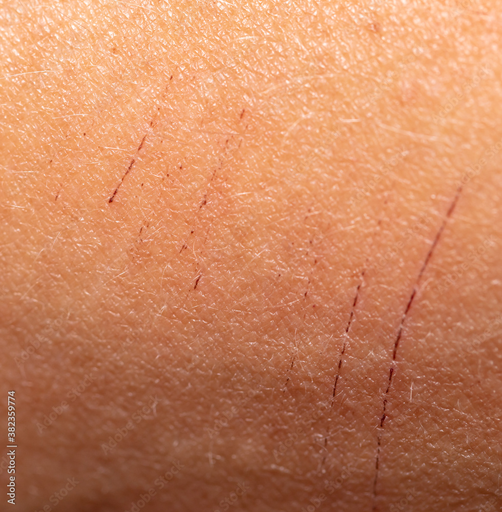 Scratches on human skin as background. Stock Photo | Adobe Stock