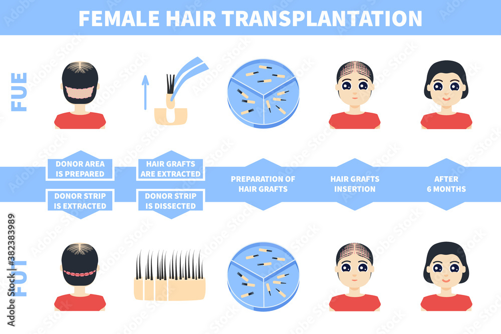 Female Alopecia Treatment With Fue And Fut Methods Follicular Unit