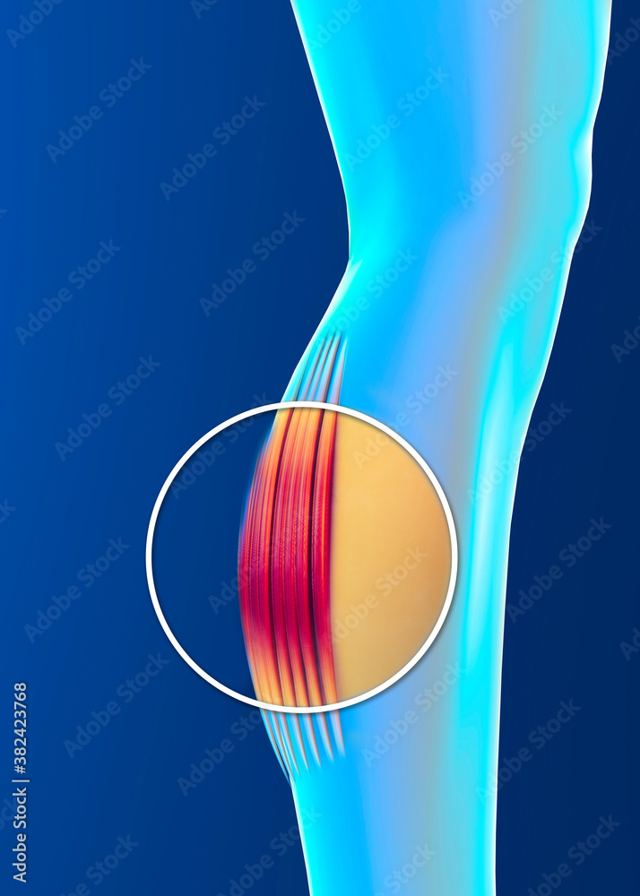 Muscle strain, inflammation of the muscles. Calf. Cramps. Tendons ...