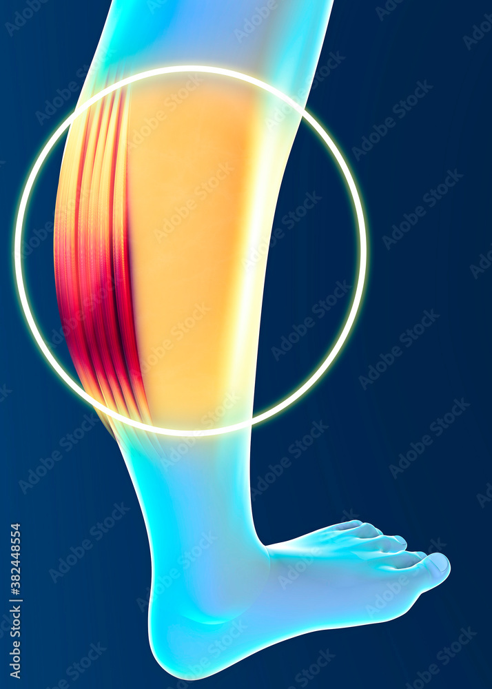 Muscle strain, inflammation of the muscles. Calf. Cramps. Tendons ...