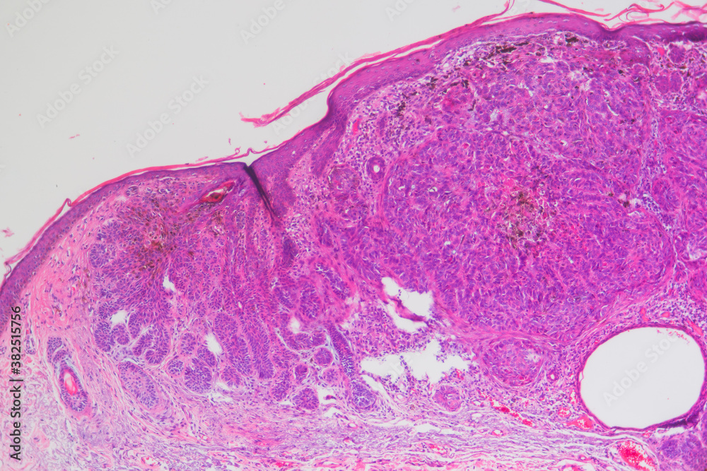 micrograph of human basal cell cancer Stock Photo | Adobe Stock