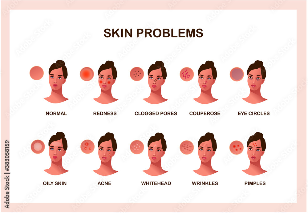 Skin conditions and problems vector infographics, skincare and ...