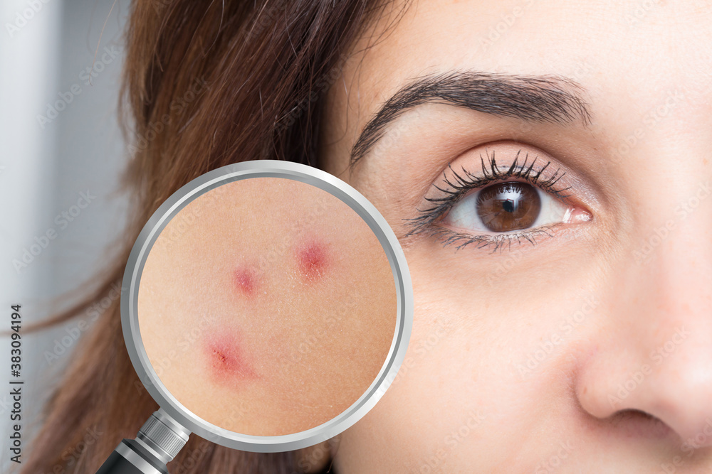 Portrait of girl with demodicosis. Magnification of a portion of skin ...