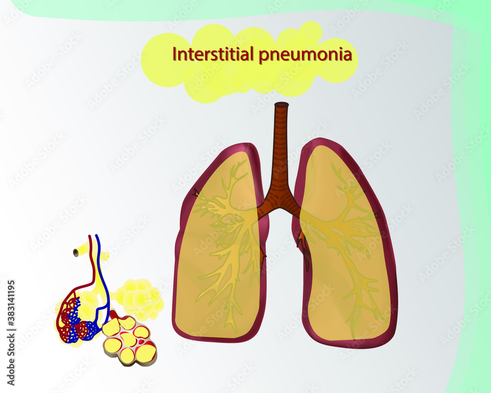 Interstitial pneumonia. Vector graphics. The symbol of light. Alveoli ...
