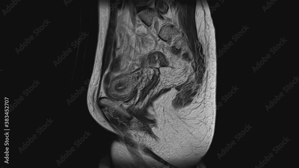 Voluminous MRI of the female pelvic organs, abdominal cavity ...