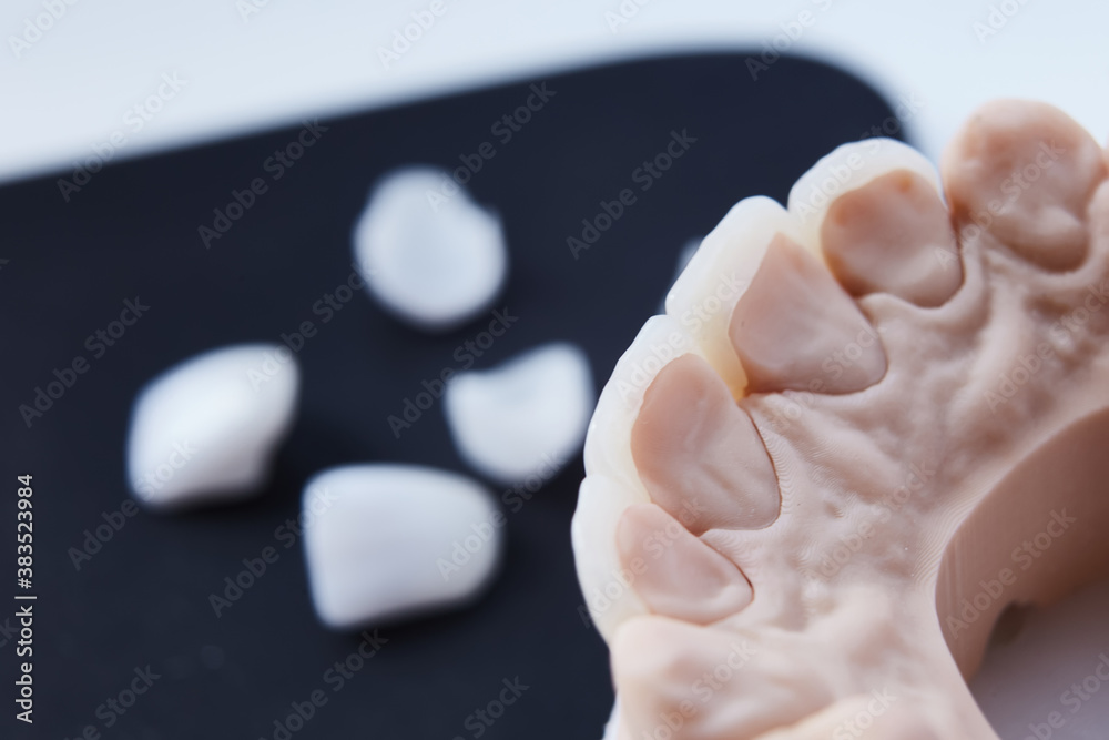 Ceramic dental veneers. Close-up view of dental layout of lower row of ...