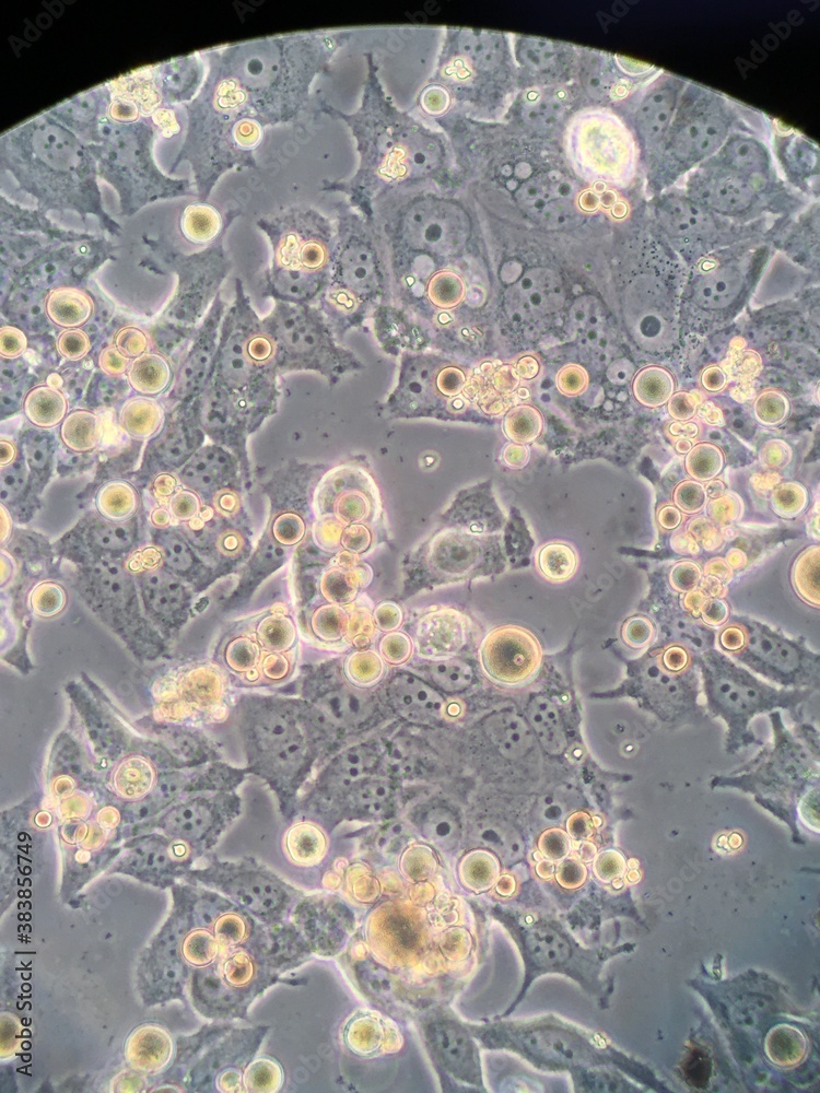 Human cancer cells with nanoparticles under the microscope Stock Photo ...