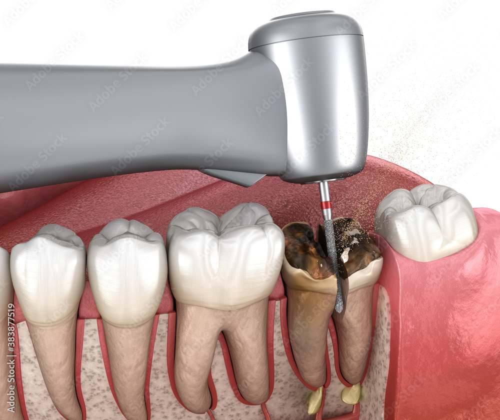 Complex tooth extraction. Medically accurate 3D illustration of dental ...