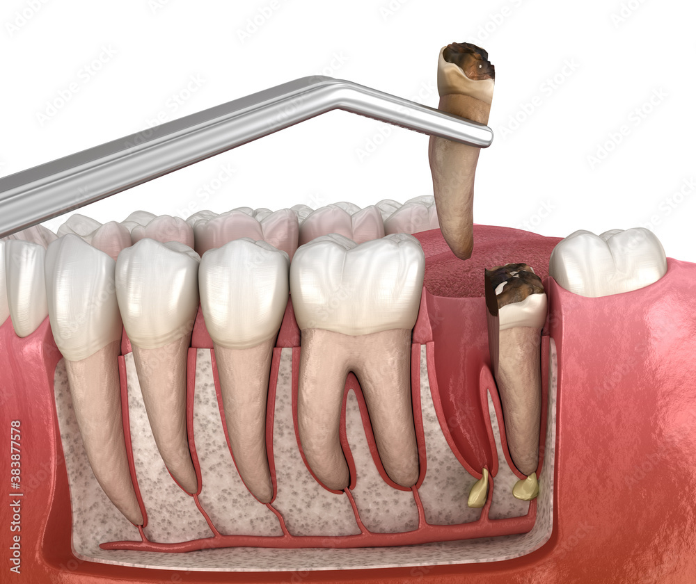 Complex tooth extraction. Medically accurate 3D illustration of dental ...