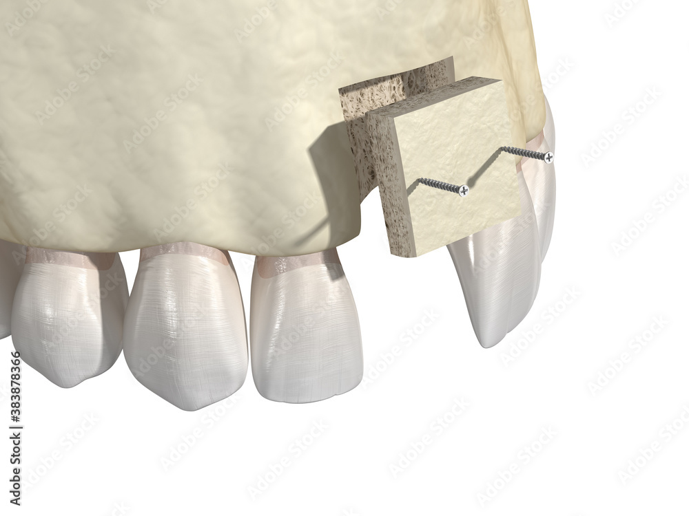 Bone grafting- augmentation using block of bone, tooth implantation ...