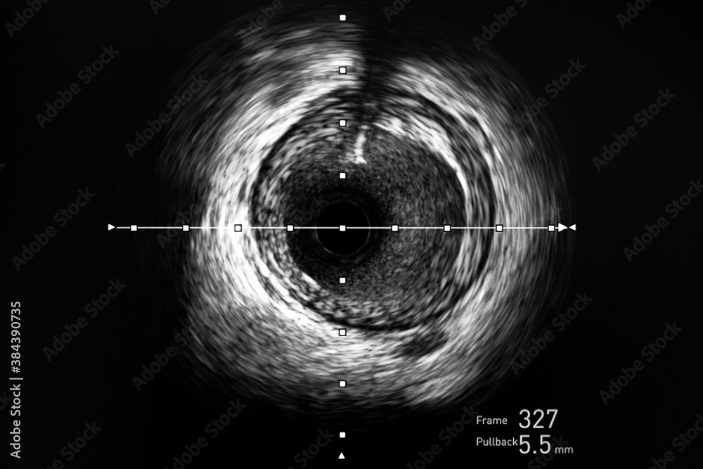 Intravascular ultrasound imaging (IVUS) for assessment inside coronary artery, cardiac ...