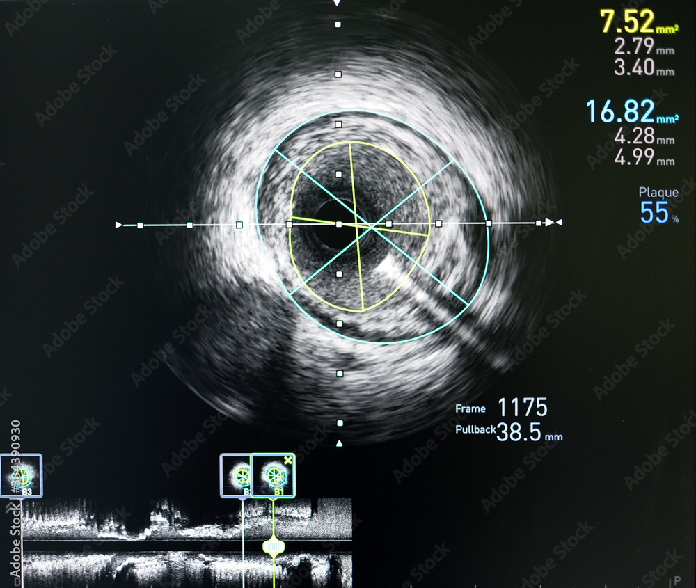 Intravascular ultrasound imaging (IVUS) for assessment inside coronary ...