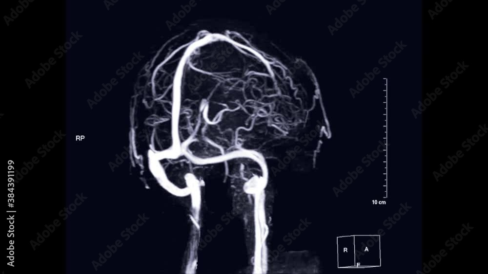 MRV Brain or magnetic resonance venography of The Brain 3D mip view ...