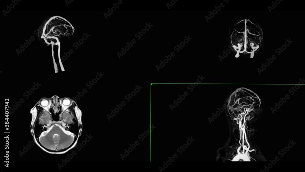 Comapre MRV Brain or magnetic resonance venography of The Brain Axial ...