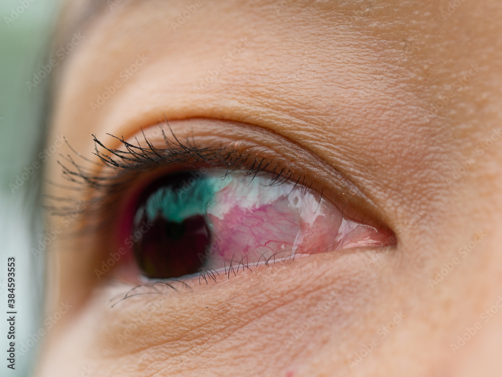 the women have a Pinguecula in her eye Stock Photo | Adobe Stock
