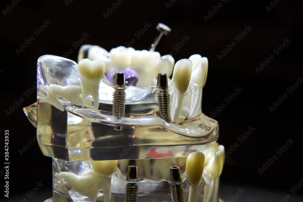 Dental implants made of titanium. The layout of the plastic jaw with ...
