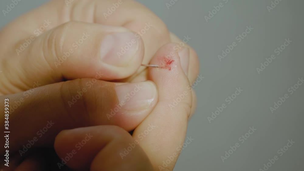 Method for self-removal of warts. Wart Removale Procedure using a ...