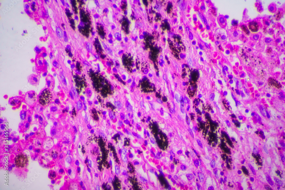 Viral pneumonia disease human cells Stock Photo | Adobe Stock