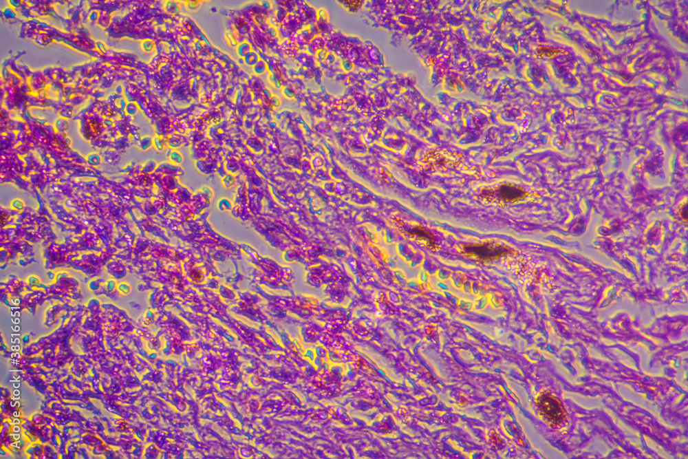 Viral pneumonia disease human cells Stock Photo | Adobe Stock