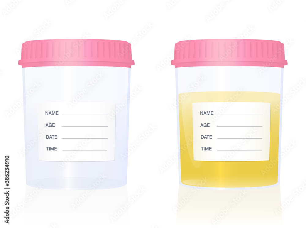 Urine sample - specimen cups for gynecological analysis - with blank ...