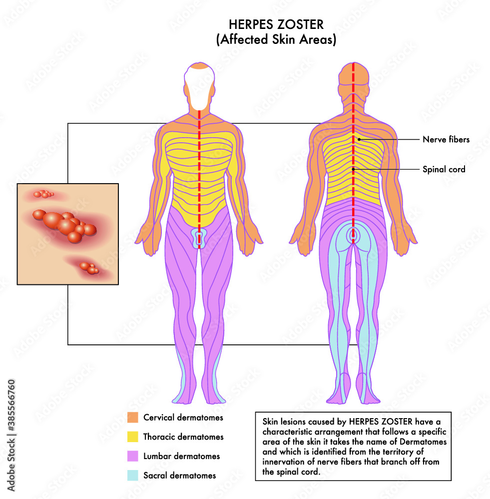 Medical diagram of affected skin areas of Herpes Zoster with ...